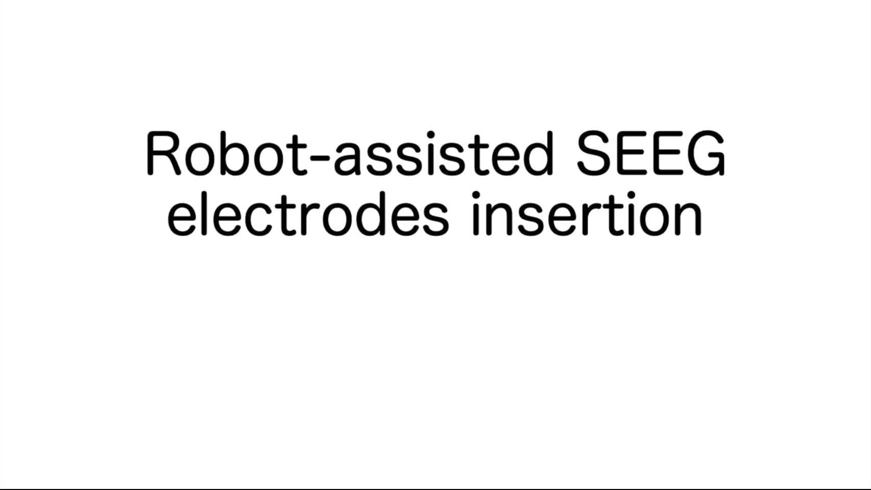 Rosa One®によるSEEGの電極留置